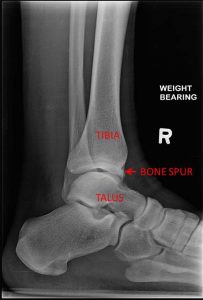 What is an ankle cheilectomy? - Orthopedic Specialists of Seattle