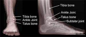 What is talar fracture surgery? - Orthopedic Specialists of Seattle