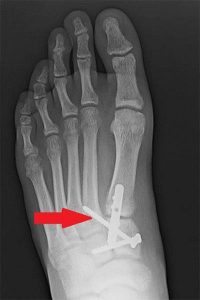 What is Lisfranc surgery? - Orthopedic Specialists of Seattle
